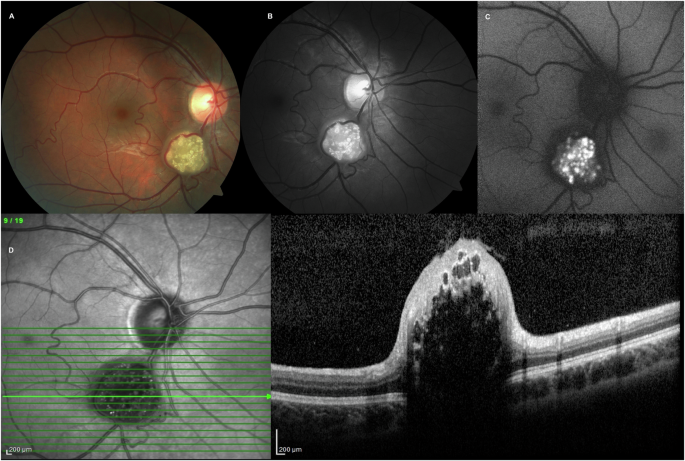 Multimodal imaging of retinal astrocytoma in a patient with tuberous ...