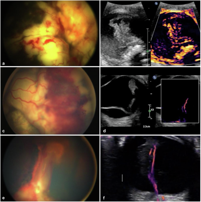 Microvascular flow ultrasound imaging for paediatric retinal conditions ...