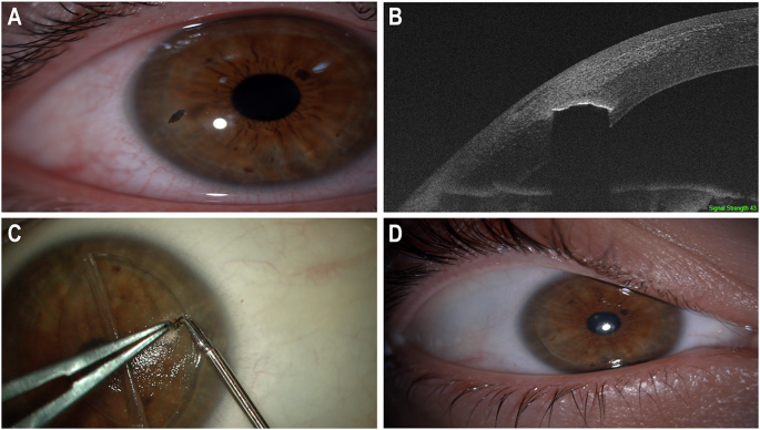 Management of corneal intrastromal metallic foreign body in a post ...