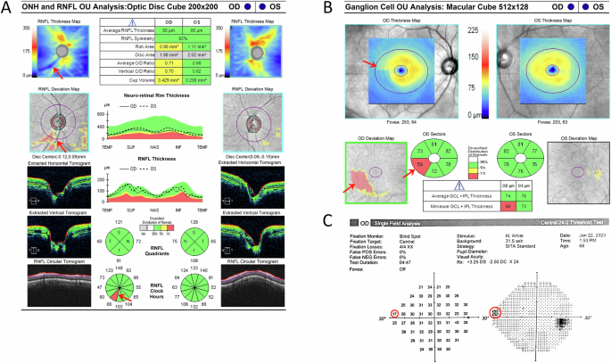 Overlooking early glaucoma with an apparently normal OCT RNFL: beware ...