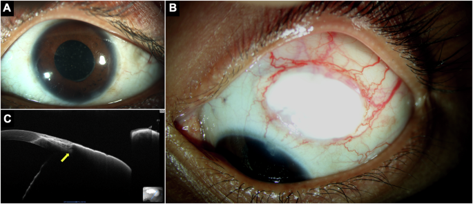 Conjunctival triamcinolone cyst | Eye