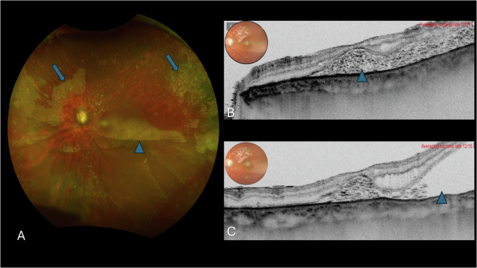 Subretinal hyperoleon: the bubble trouble | Eye