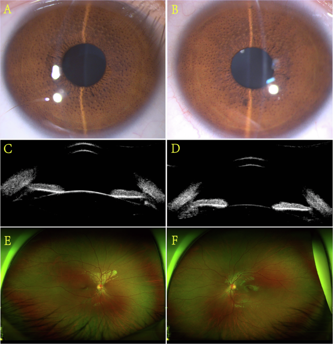 Bilateral iris mammillations: a rare congenital abnormality | Eye