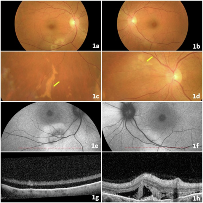 Exudative retinal detachment as a presentation of systemic lupus ...