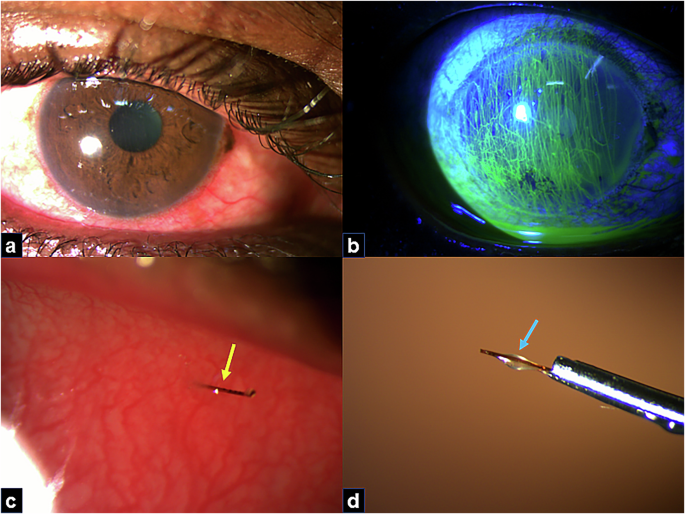 The hidden sting: unmasking corneal ice rink sign in a bee sting injury ...