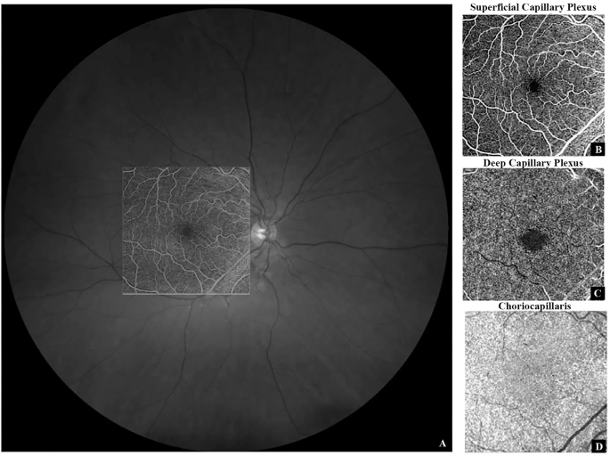 Retinal optical coherence tomography angiography (OCTA) biomarkers of ...