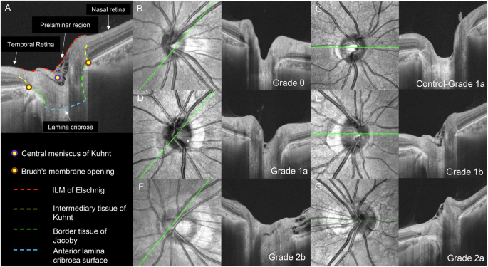 Clinical features of high myopia with optic nerve head prelaminar ...
