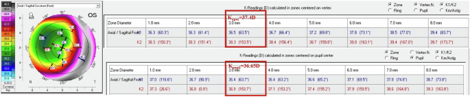 Intraocular lens power calculation in post-myopic-LASIK eyes ...
