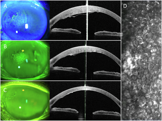 Invigorating effect on corneal endothelium observed with ripasudil | Eye