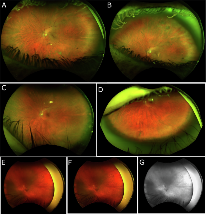 Sensitivity and utility of ultra-wide field imaging for the detection ...