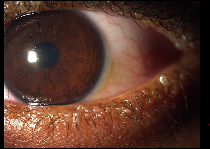 Moniliform blepharosis: a pathognomonic feature of lipoid proteinosis | Eye