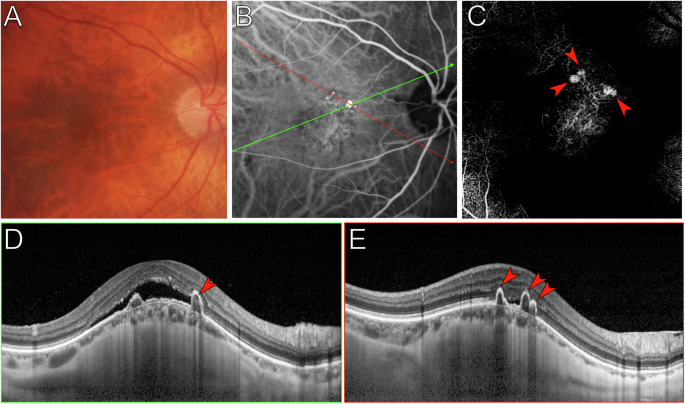 Aneurysmal type 1 macular neovascularization associated with dome ...