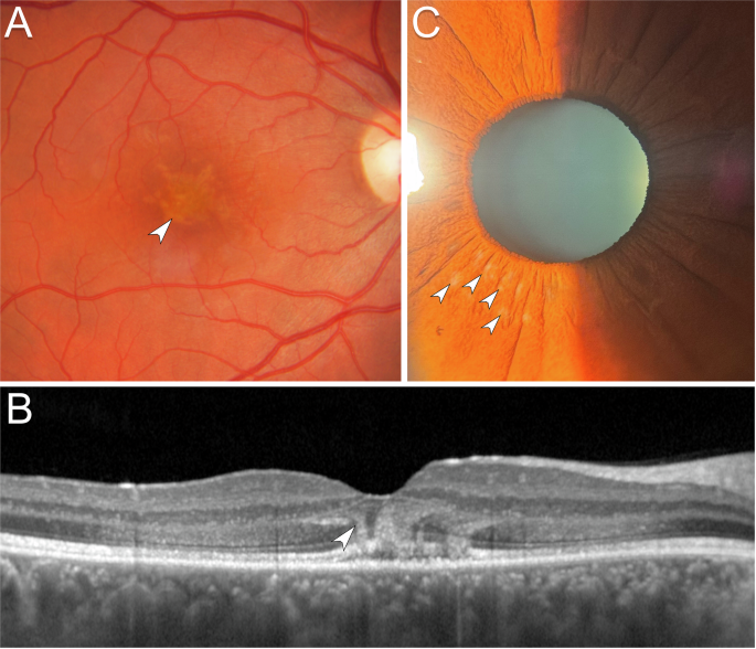 Iris micro-burns associated with laser pointer maculopathy | Eye