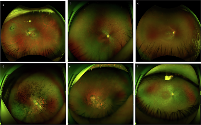 Comparative analysis of generic vision-language models in detecting and diagnosing inherited ...