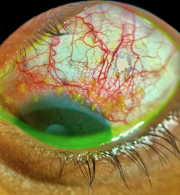 Splendore–Hoeppli phenomenon in vernal keratoconjunctivitis: a rare ...