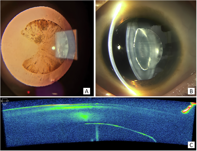“Pac-Man” appearance of an atypical zonular cataract | Eye