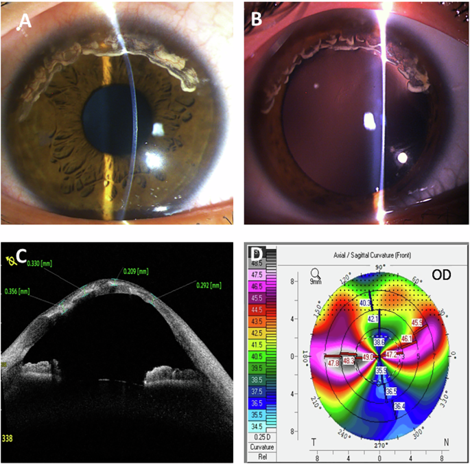 Young-onset unilateral Terrien’s marginal degeneration: a rarity within ...