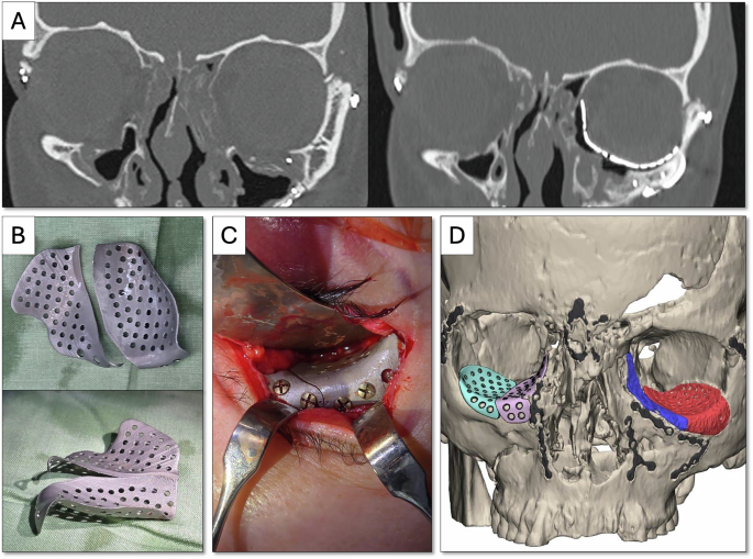 Modular two-part titanium implant for complex orbital reconstruction | Eye