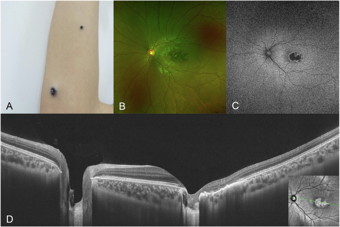 Pigmented chorioretinal scar in a child with blue rubber-bleb nevus ...