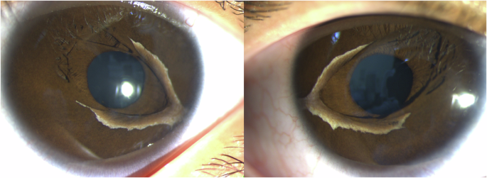 Bilateral heterochromic dyscoria resembling eagle eyes | Eye