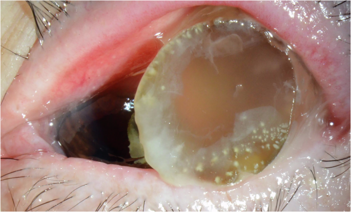 Forgotten but not gone: late extrusion of a MIRAgel scleral buckle ...