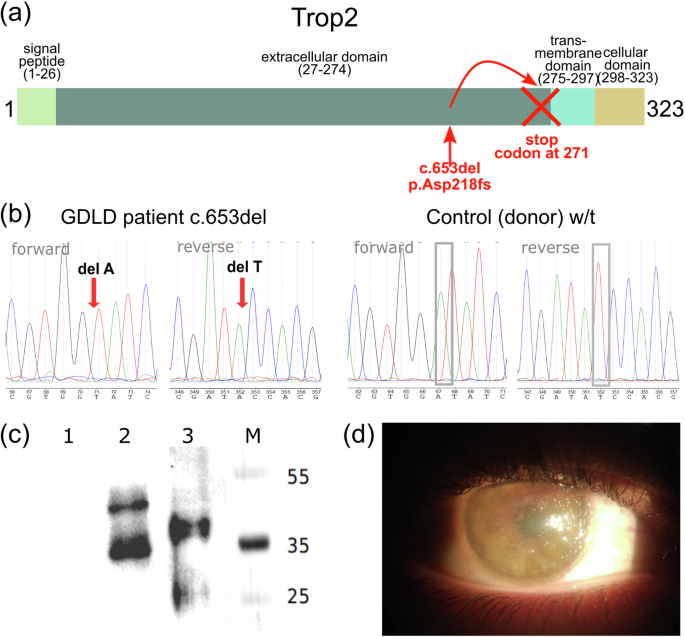 TACSTD2 in gelatinous drop-like corneal dystrophy: variant functional ...
