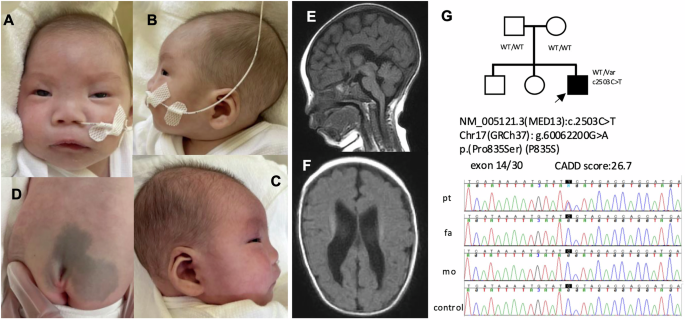 Mitochondrial dysfunction in MED13 variant-associated disease: a case ...