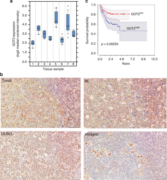 Cooperative STAT/NF-κB signaling regulates lymphoma metabolic ...