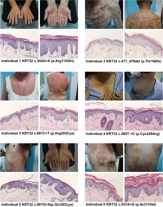 Loss-of-function mutations in Keratin 32 gene disrupt skin immune ...