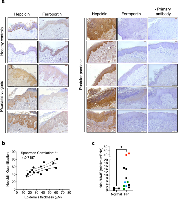Skin hepcidin initiates psoriasiform skin inflammation via Fe-driven ...