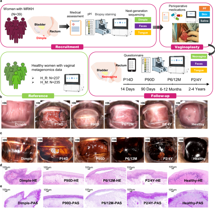 Insights into the assembly of the neovaginal microbiota in Mayer ...