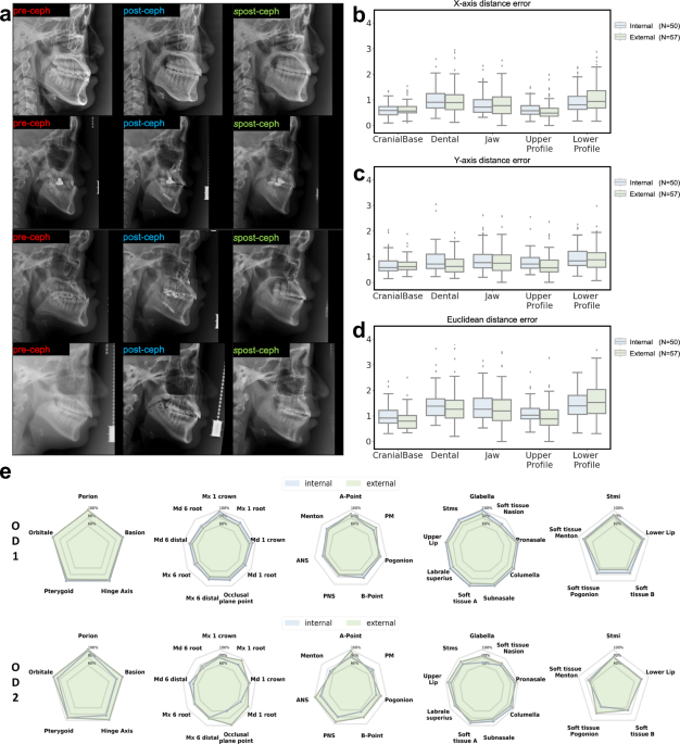 Predicting orthognathic surgery results as postoperative lateral ...