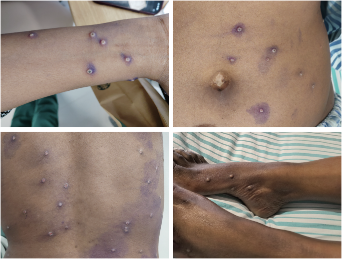 Characteristics of the first confirmed case of human infection with ...
