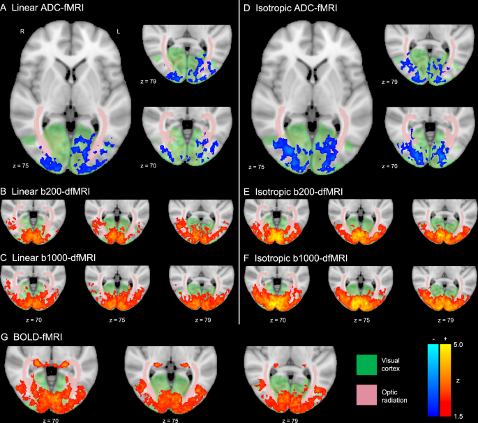 Mapping grey and white matter activity in the human brain with isotropic ADC-fMRI | Nature ...