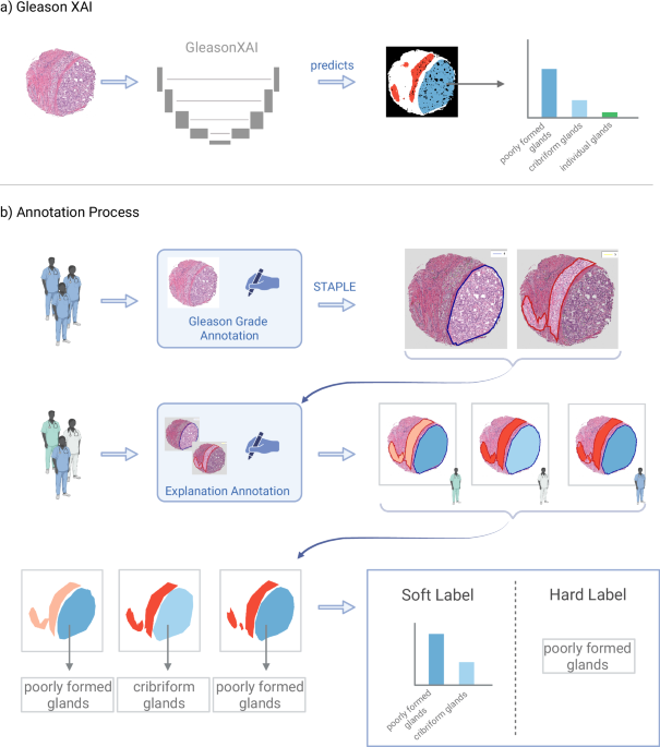 Pathologist-like explainable AI for interpretable Gleason grading in ...