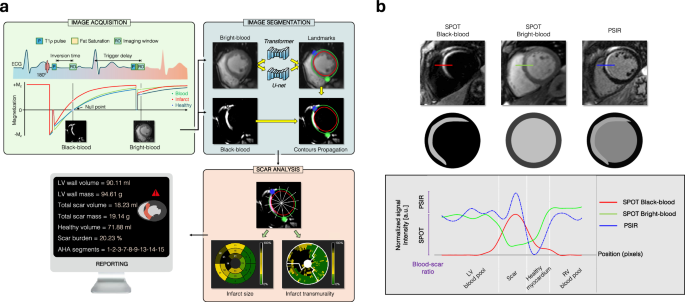 AI-powered SPOT imaging for enhanced myocardial scar detection and ...