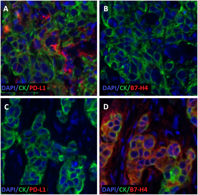 Association Of B7 H4 Pd L1 And Tumor Infiltrating Lymphocytes With