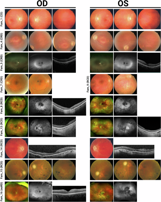 Coding and non-coding variants in the ciliopathy gene CFAP410 cause ...