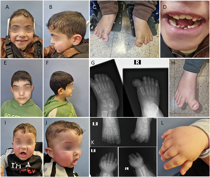 A ciliopathy combining Joubert syndrome and Oro-Facial-Digital syndrome ...