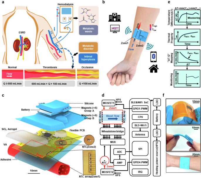 Self-adaptive epidermal blood flow sensor for high-flux vascular access ...
