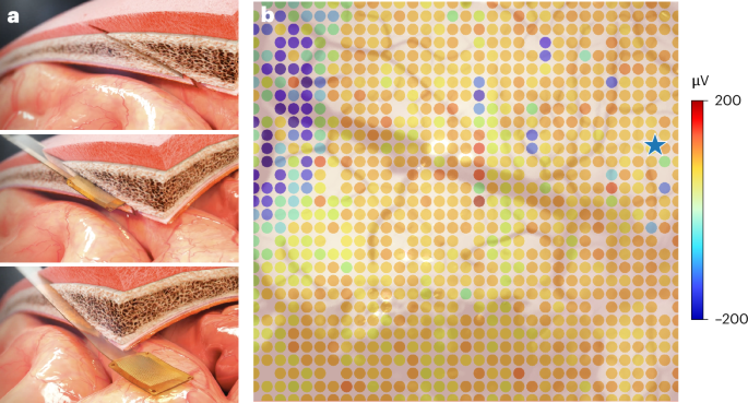 High-resolution brain–computer interface with electrode scalability and minimally invasive ...
