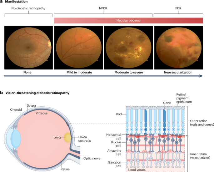 Diabetic retinal disease | Nature Reviews Disease Primers