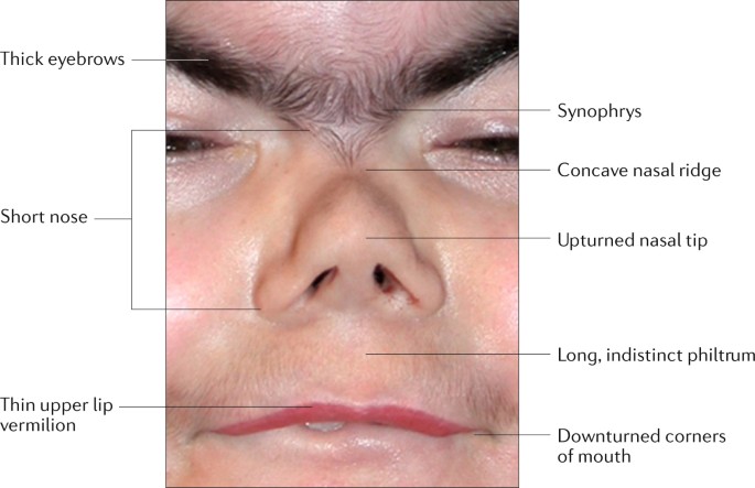 Diagnosis and management of Cornelia de Lange syndrome: first ...