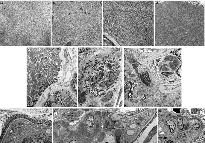 The evaluation of monoclonal gammopathy of renal significance: a ...