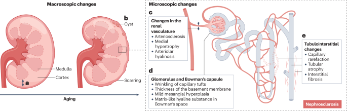 Treatment of chronic kidney disease in older populations | Nature ...