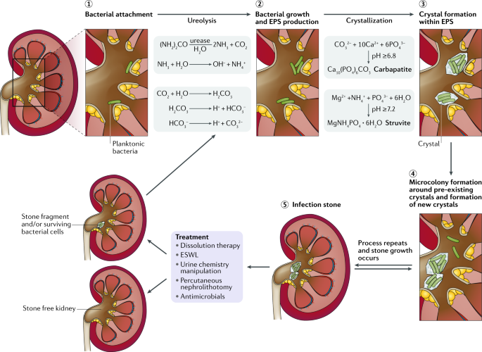 Current insights into the mechanisms and management of infection stones ...