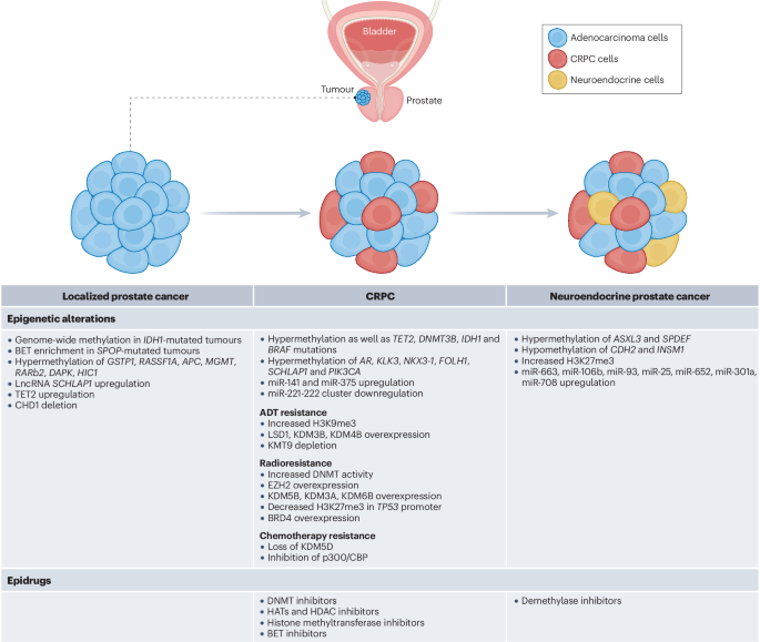 Prostate cancer epigenetics — from pathophysiology to clinical application | Nature Reviews Urology
