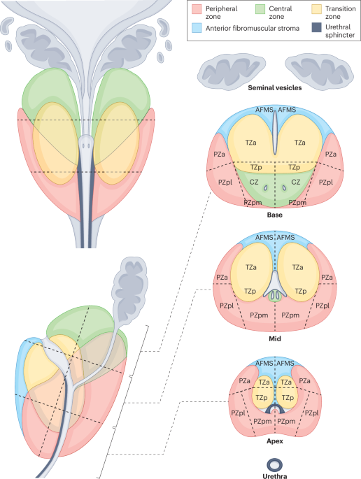 Epidemiology, diagnosis and treatment of anterior prostate cancer ...