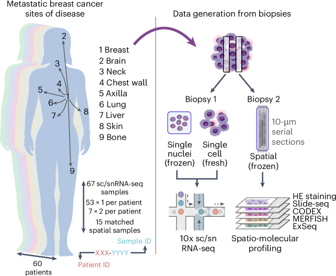 Mapping Metastatic Breast Cancer Complexity Through Single Cell And