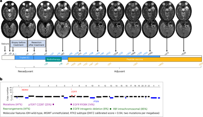Neoadjuvant triplet immune checkpoint blockade in newly diagnosed ...